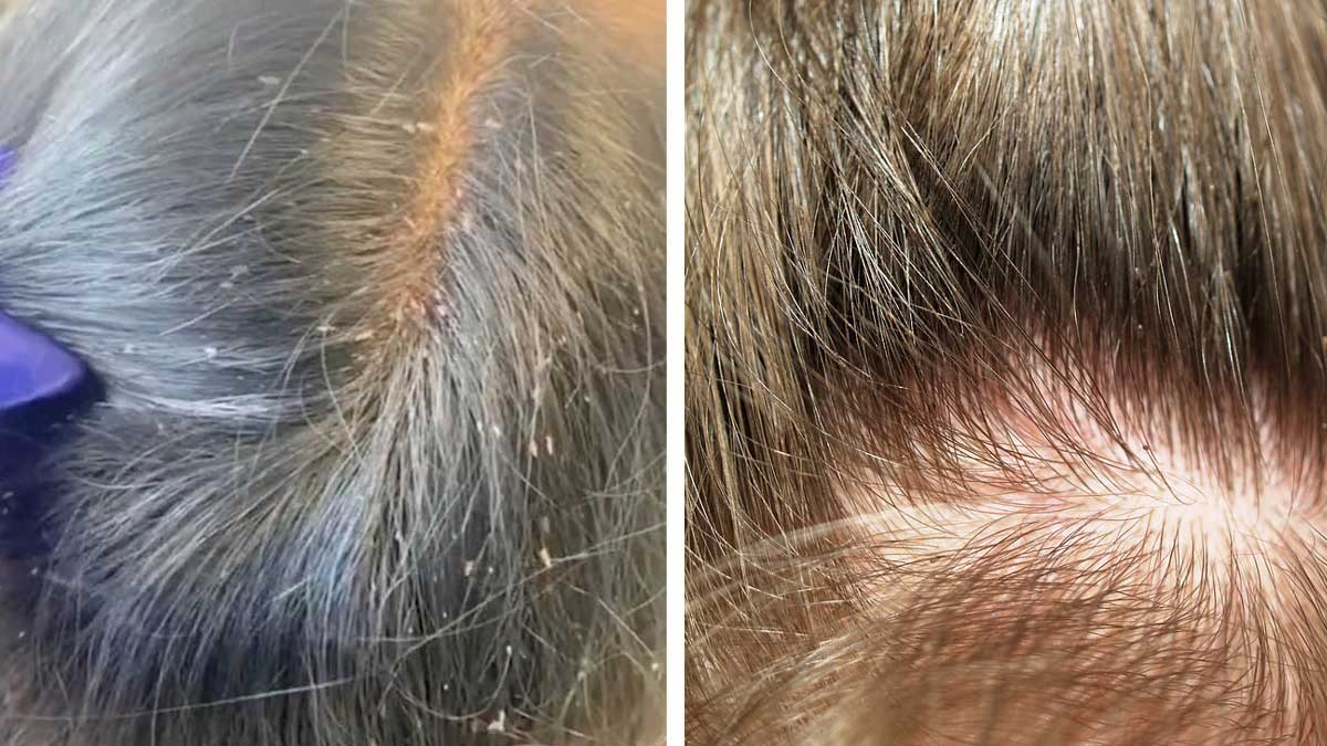 Lice : త‌ల‌లో పేలు బాగా ఉన్నాయా.. అయితే ఇలా చేయండి.. దెబ్బ‌కే పోతాయి ...