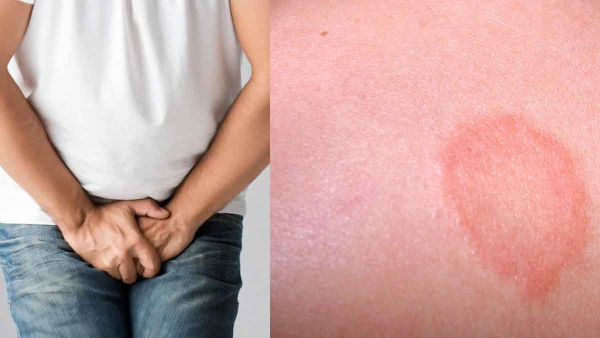 Skin Infection : తొడ‌లు, గ‌జ్జ‌ల్లో ఇలా దుర‌ద‌లు వ‌స్తూ.. ఇన్‌ఫెక్ష ...